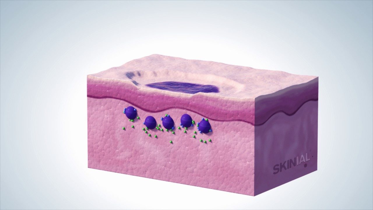 How does cosmetic tattoo removal without laser with SKINIAL work | SKINIAL
