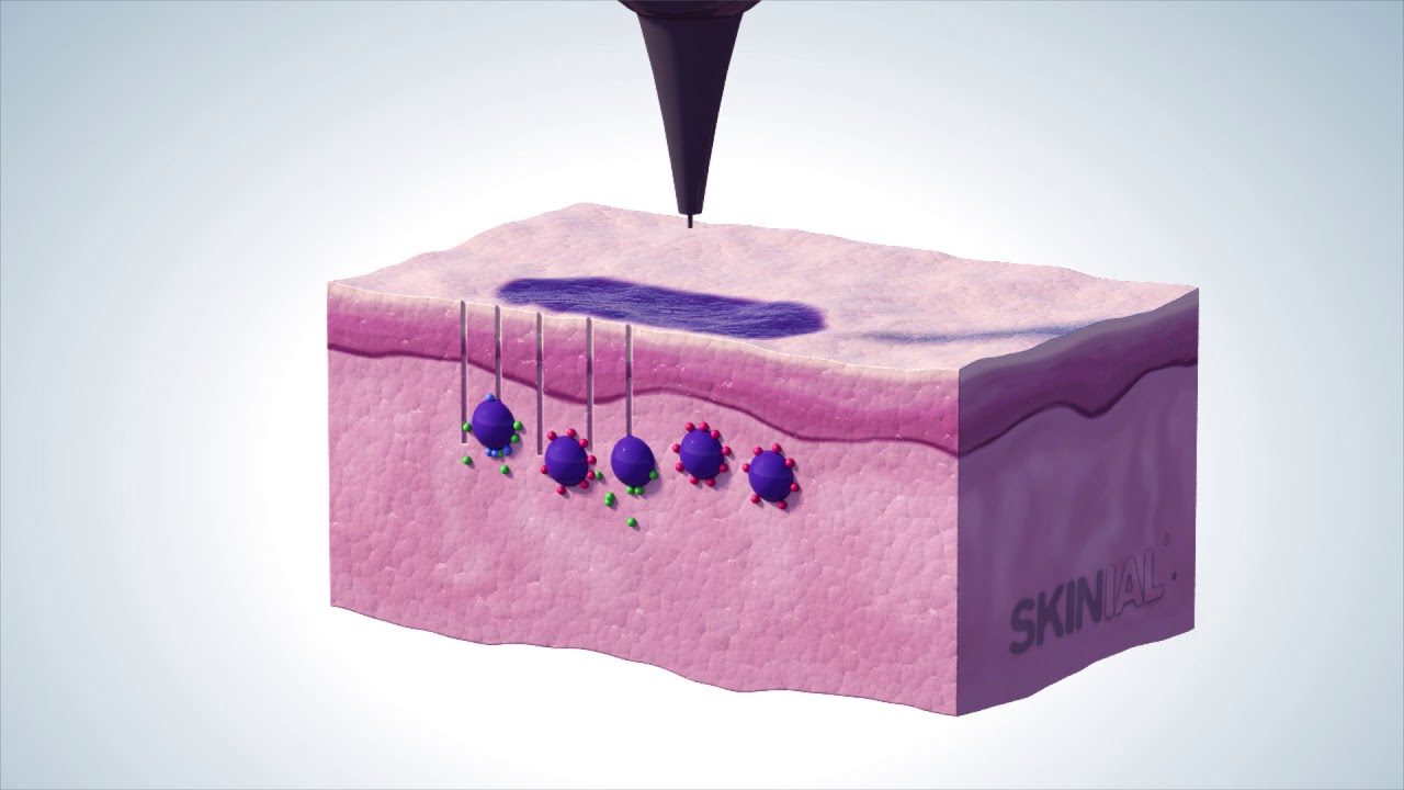 How does cosmetic tattoo removal without laser with SKINIAL work | SKINIAL
